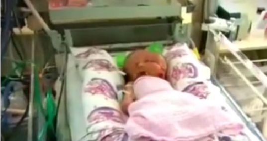 Baby Born With Two Faces, Brain's Still Alive, Doing Well: 'We Just ...