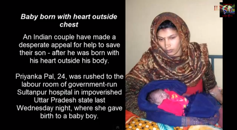 Baby Born With Heart Outside Chest - 'God Has Plans,' Father Says of Son
